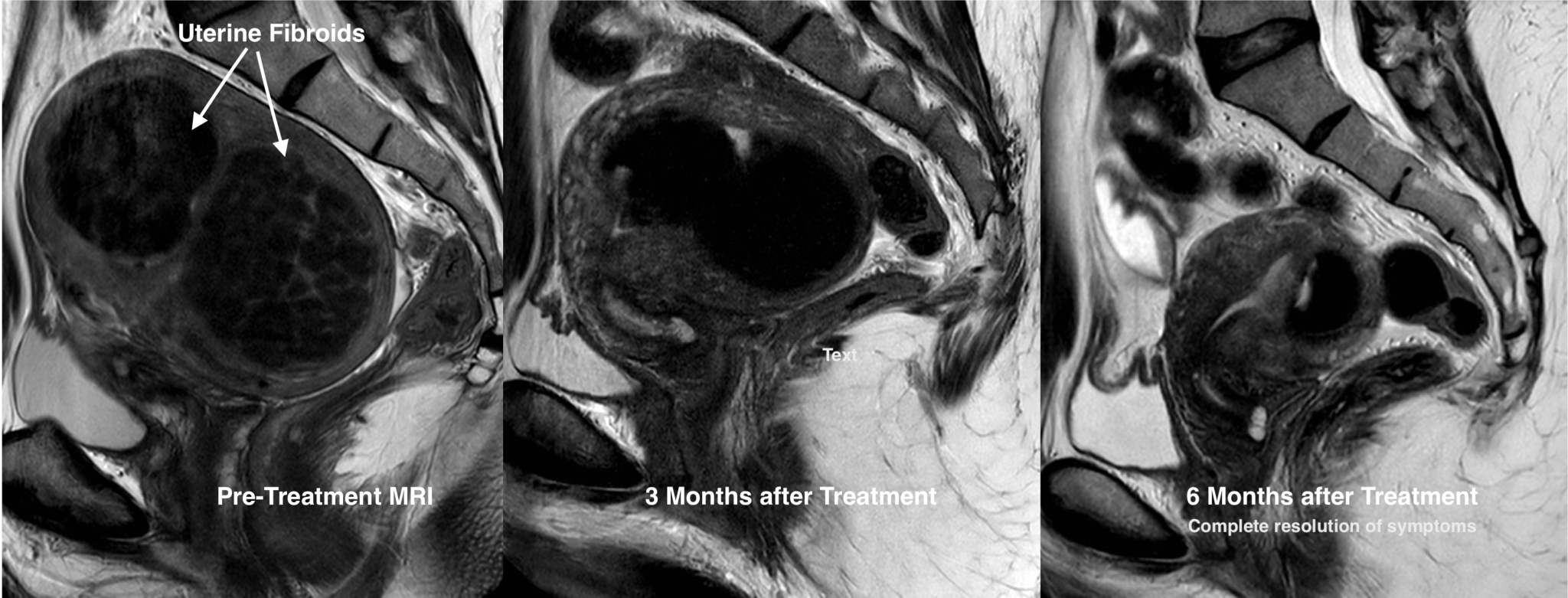 Varicocele Embolisation | Lumina Interventional Radiology