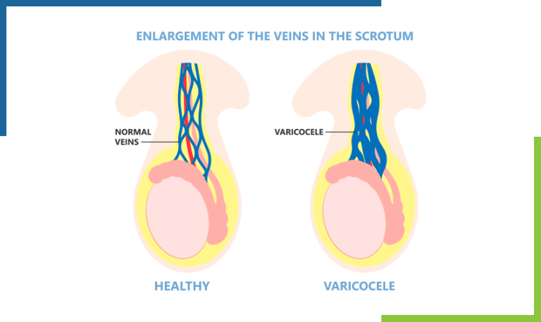 Varicocele Embolisation | Lumina Interventional Radiology Varicocele Embolisation | Lumina Interventional Radiology